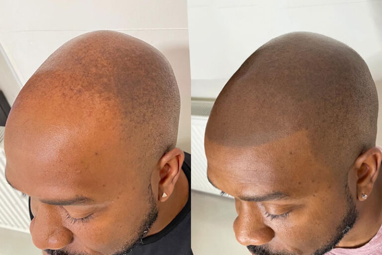 Scalp Micropigmentation Alopecia Areata & Totalis | BLADE SMP